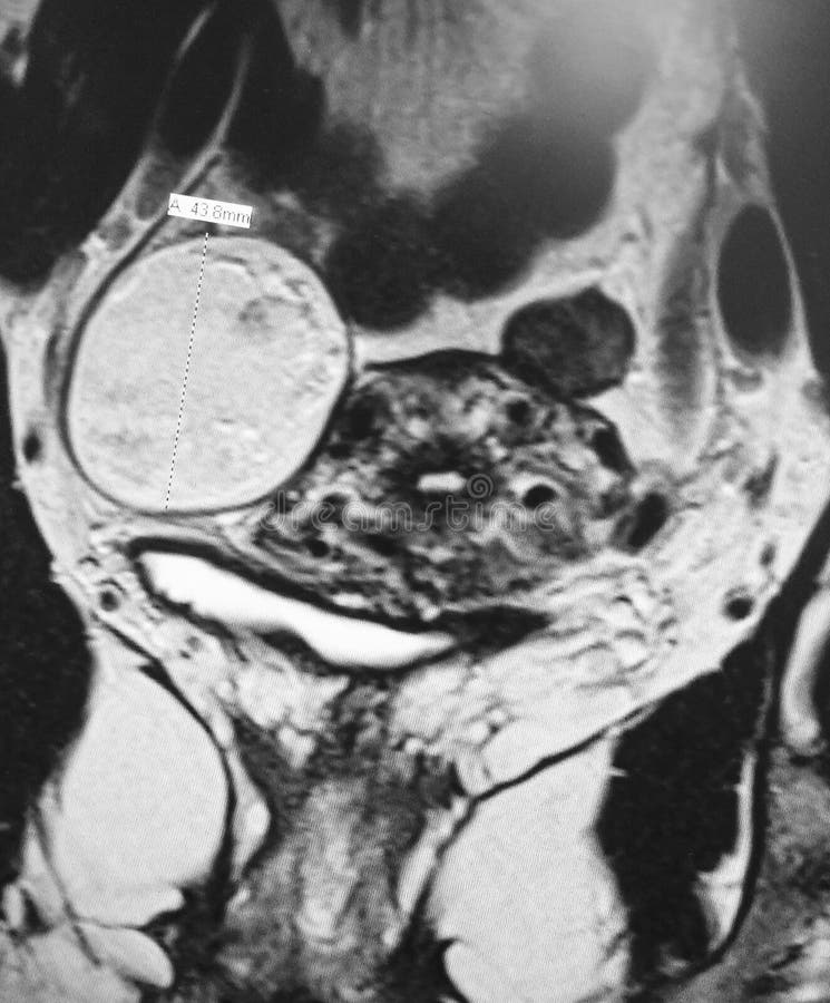 Examen Ovárico Raro Del Mri De La Patología De Teratoma Foto De Archivo