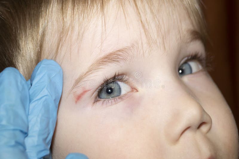 Examination of the Child`s Wound Above the Eye Stock Photo - Image of ...