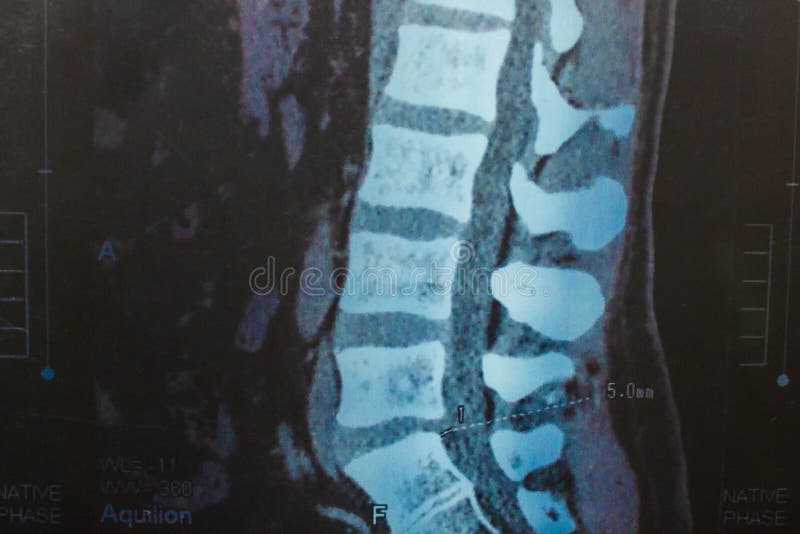 Spine Rengen picture stock image. Image of doctor, diagnosis - 85341363