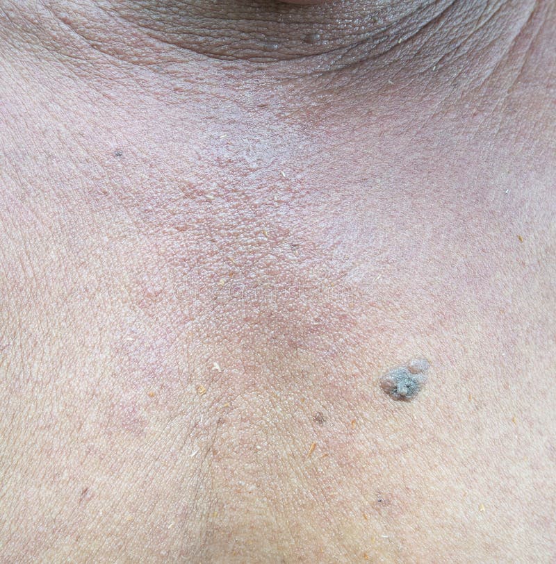 Excess Skin Lumps on the Body Stock Photo - Image of complaint, texture ...