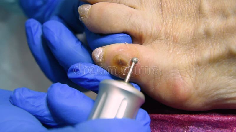 Excision of Calluses on the Toe with a Pedicure Machine Stock Video ...