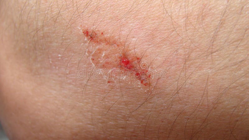 Excoriation Wound on an Arm | Wound Healing . Medicine Stock Photo ...