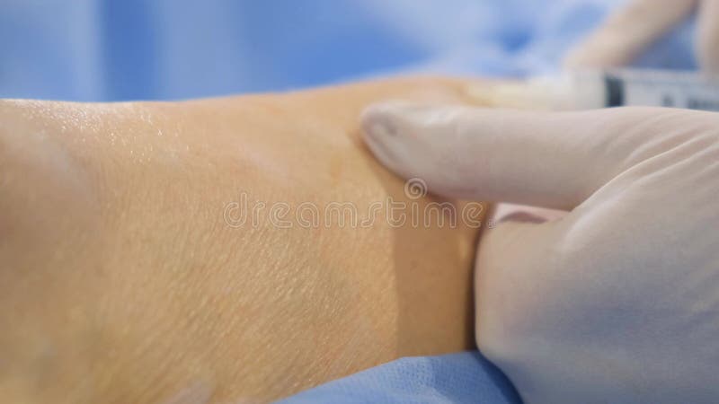 Experienced Surgeons Perform a Complex Procedure for Varicose Veins. a ...