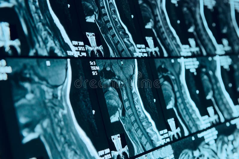 Exploración De La Cabeza Y Del Cuello MRI, Anonymized Imagen de archivo ...