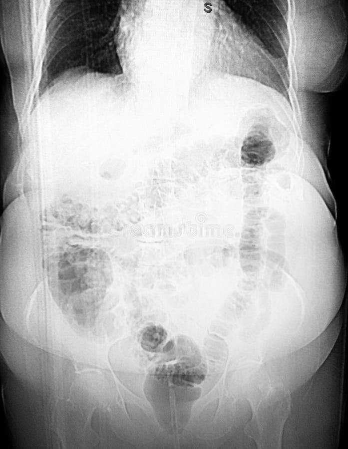 Exploración Moderada Del Ct De La Diverticulosis De La Colonoscopia ...