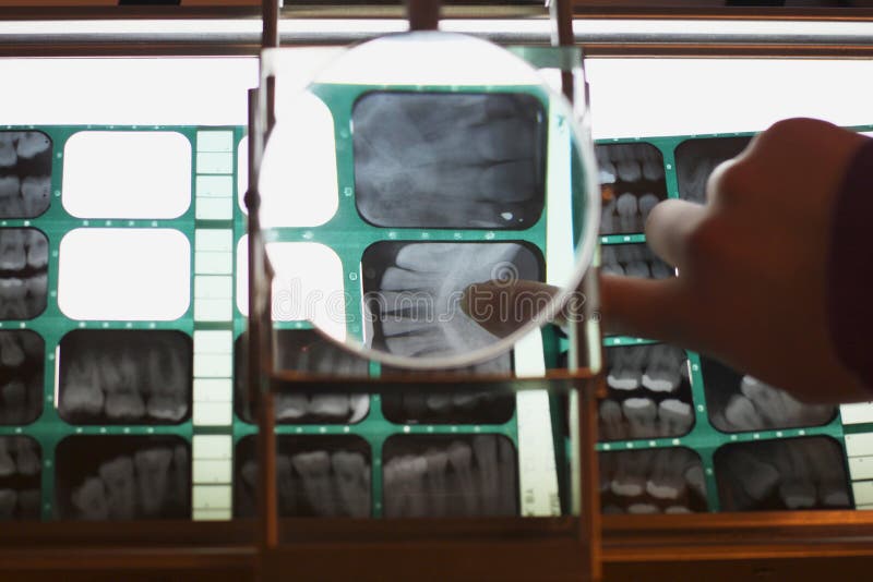 Exploring Teeth X-ray Under the Magnifying Glass Stock Image - Image of ...