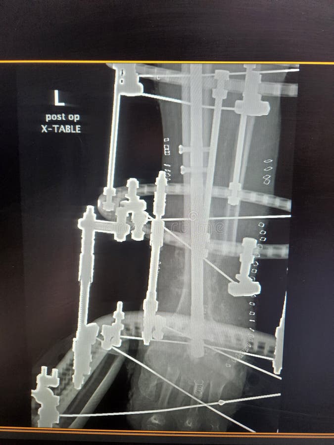 Extensive External Fixator Devices in Fracture Patient Stock Image ...