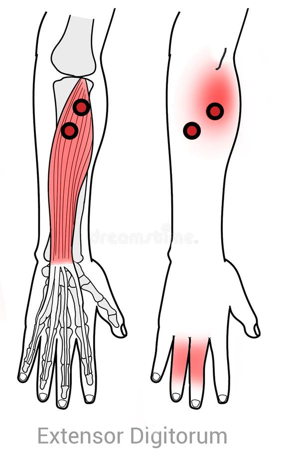 Extensor Digitorum Myofascial Trigger Points Can Cause Pain Around the ...