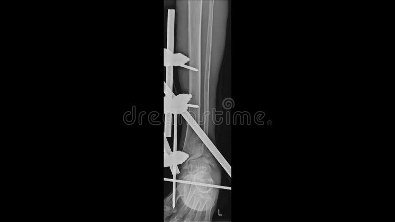 External Fixation of Tibia X-ray Imaging: Detailed Assessment of ...