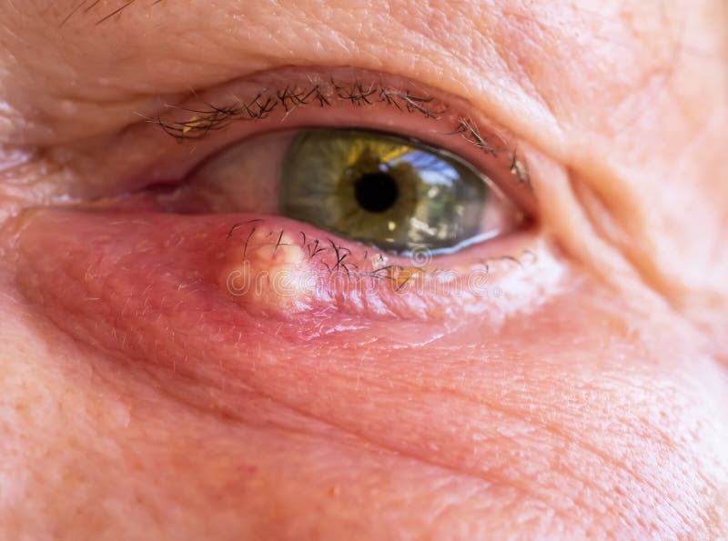 241 Stye Infection Stock Photos - Free & Royalty-Free Stock Photos from ...