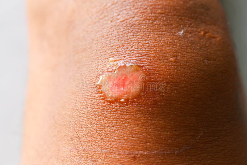 External Wounds 1 stock image. Image of band, children - 331163779