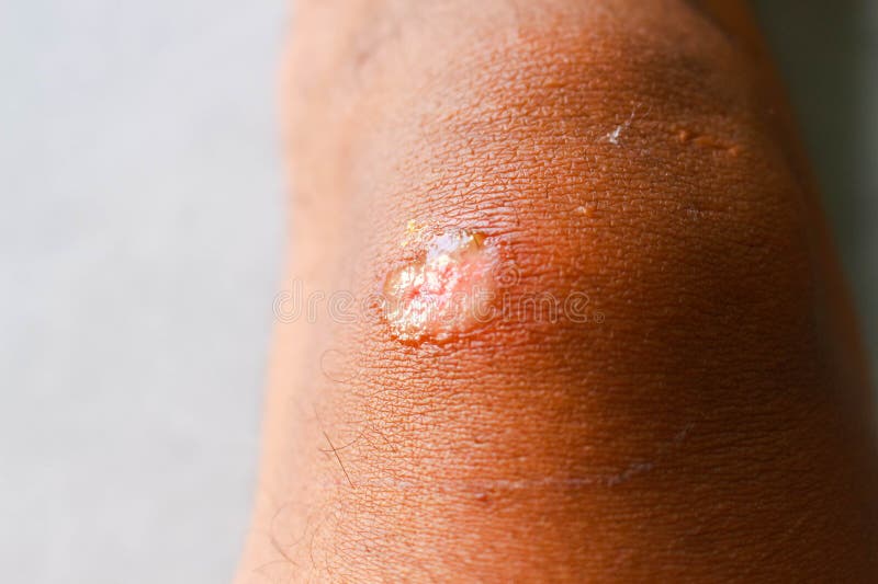 External Wounds 2 stock photo. Image of injured, outside - 324593584