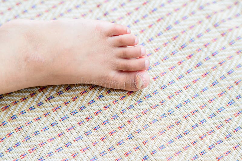 Dedo Quebrado Fotos De Stock - Descarga 590 Fotos Libres de Derechos