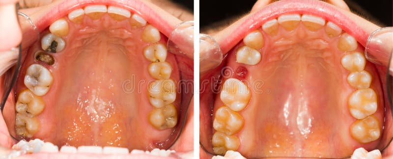 Extracción Y Resina Del Diente Foto de archivo - Imagen de boca ...