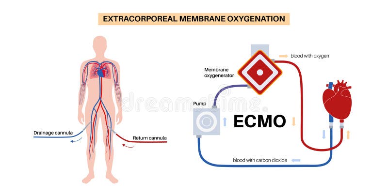 Extracorporeal Membrane Oxygenation Stock Vector - Illustration of pump ...