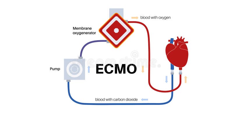 Extracorporeal Membrane Oxygenation Stock Vector - Illustration of ...