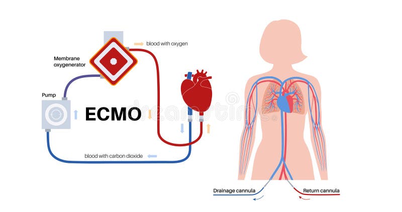 Extracorporeal Membrane Oxygenation Stock Vector - Illustration of ...