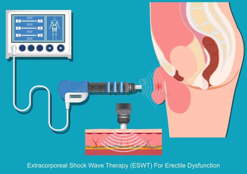 Extracorporeal Shock Wave Therapy (ESWT) for Erectile Dysfunction Stock ...