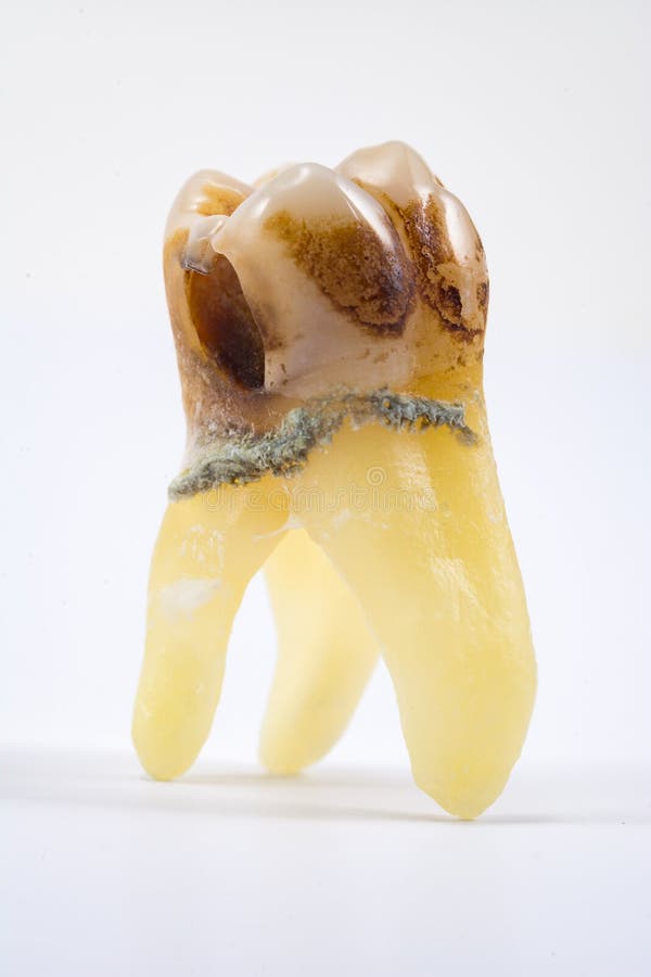 Extracted caries tooth stock photo. Image of caries - 167200658
