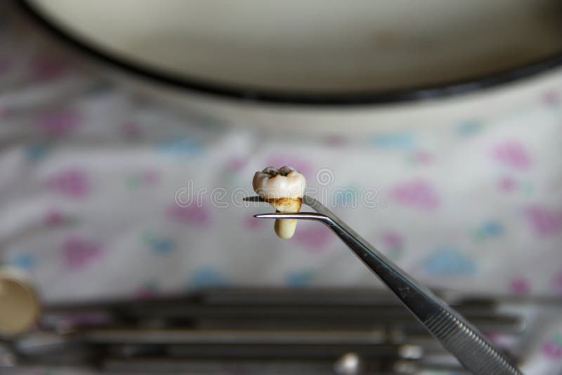 Extracted Molar Teeth with Caries Decay and Filling with Tooth Paste ...