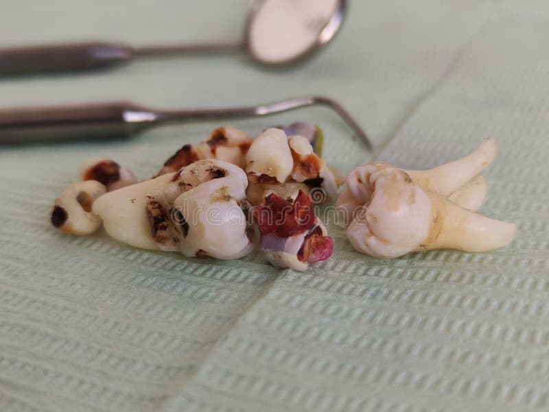 Extracted Teeth on the Background of Dental Instruments Stock Image ...