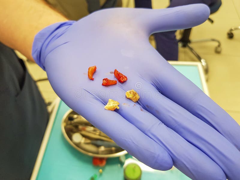 Extracted Teeth and a Dentist`s Rubber Glove Stock Image - Image of ...