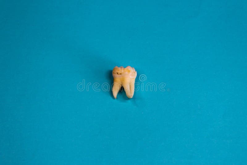 Extracted Wisdom Tooth on on Blue Background, Close Up Stock Image ...
