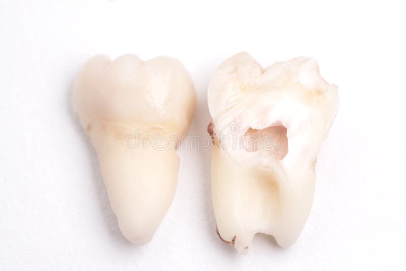 Extracted Wisdom Tooth Cut in Half on White Background Stock Photo ...
