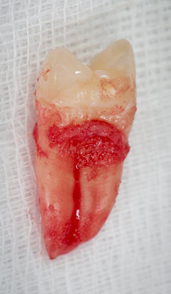 Extraction of tooth. stock image. Image of molar, blood - 25164561