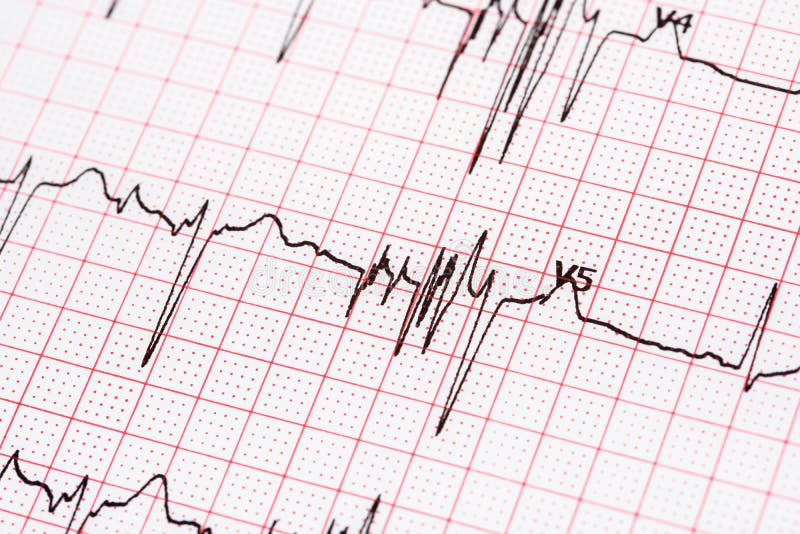 Extrasystoles on Electrocardiogram Stock Image - Image of atrial ...