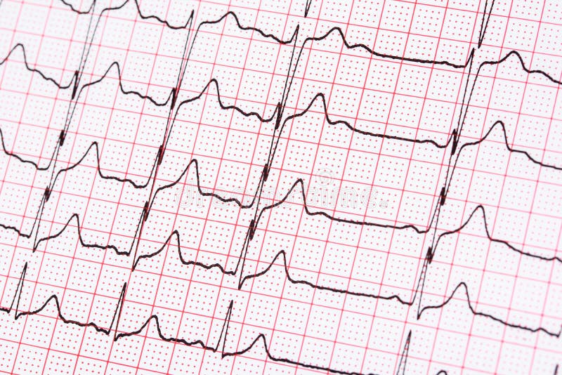 Extrasystoles En Atrial Fibrillatie Stock Foto - Image of kardiogram ...