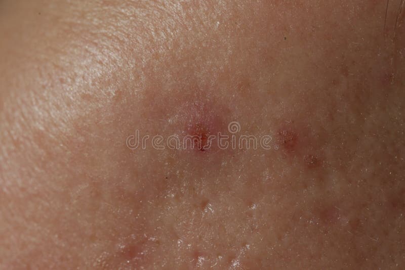 Texture of Problematic Human Skin with Large-looking Open Pores and ...