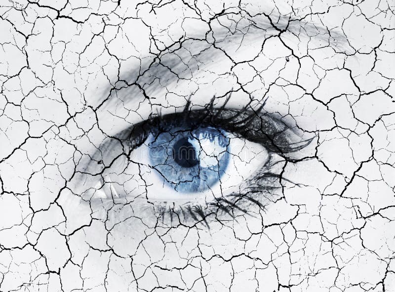 Sick Eye with Conjunctivitis Stock Photo - Image of allergy, cold: 15540728