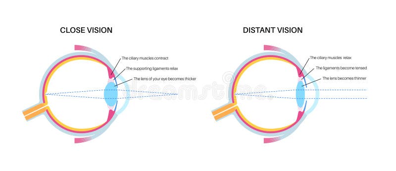 Eye accommodation poster stock vector. Illustration of tensed - 303003247
