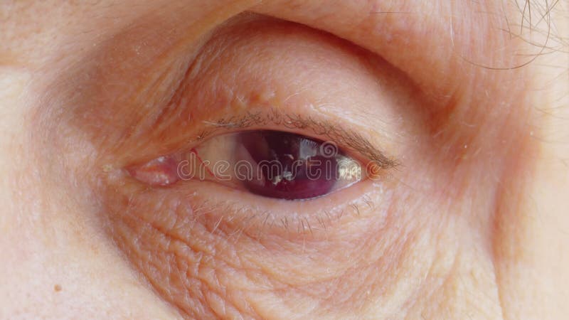 Eye with Complete Loss of Vision, Close-up. Stock Footage - Video of ...