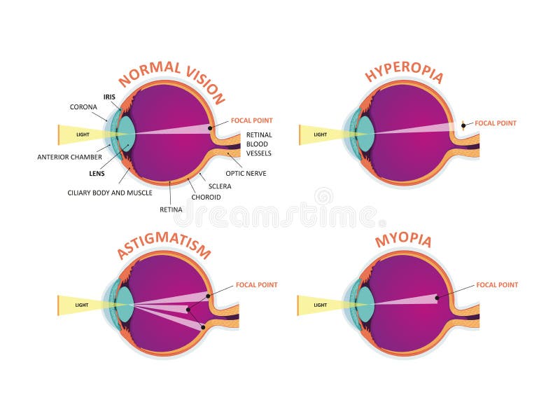 Eye Defects. Normal Vision, Hyperopia, Myopia. Stock Vector ... Eye Defects. Normal Vision, Hyperopia, Myopia. Stock Vector ...