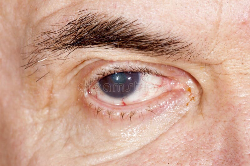 Eye disease stock photo. Image of ophthalmology, looking - 53184328