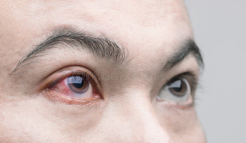 Eye Irritation Concept : Portrait Of Asian Man In Posture Of Eye Tired ...