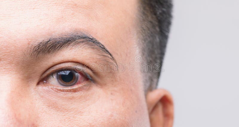 Eye Irritation Concept : Red Eye of Man, Conjunctivitis Eye or after ...