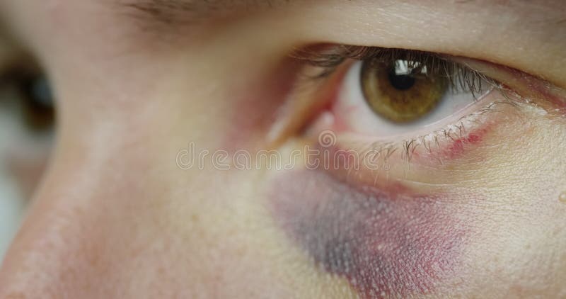 The Eye of a Man with a Bruise and Abrasions Stock Photo - Image of ...