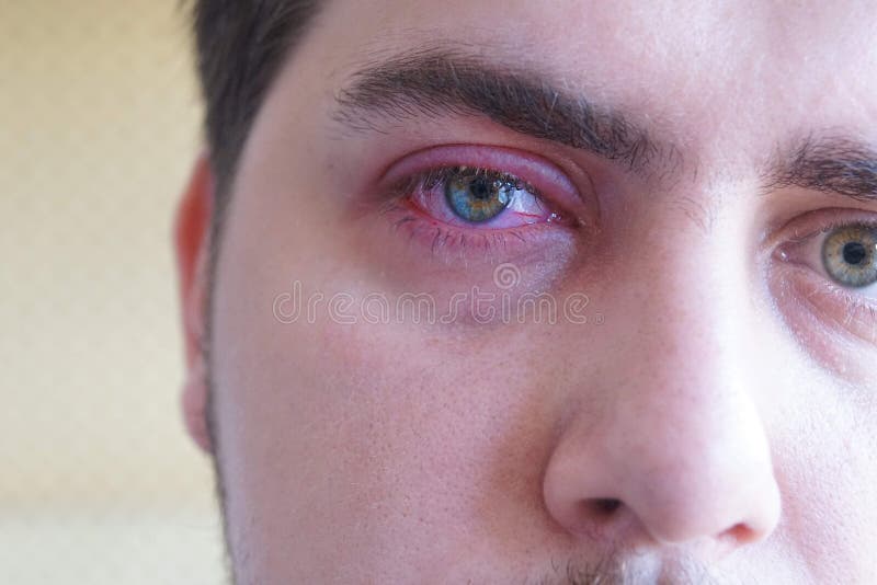 Eyelid abscess stock photo. Image of meibomian, bacteria - 120478824