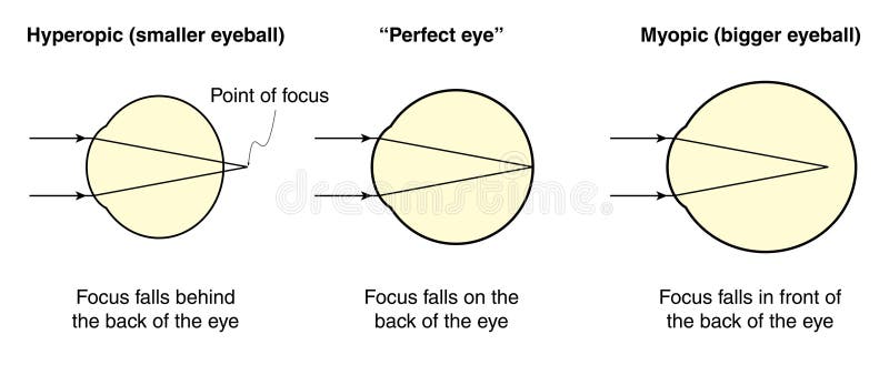 Eyes hyperopic myopic vektor illustrationer. Illustration av öga - 14218881