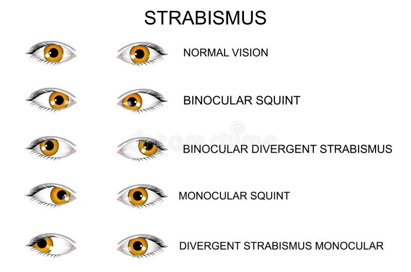 Types of strabismus-1 stock vector. Illustration of optical - 136471526