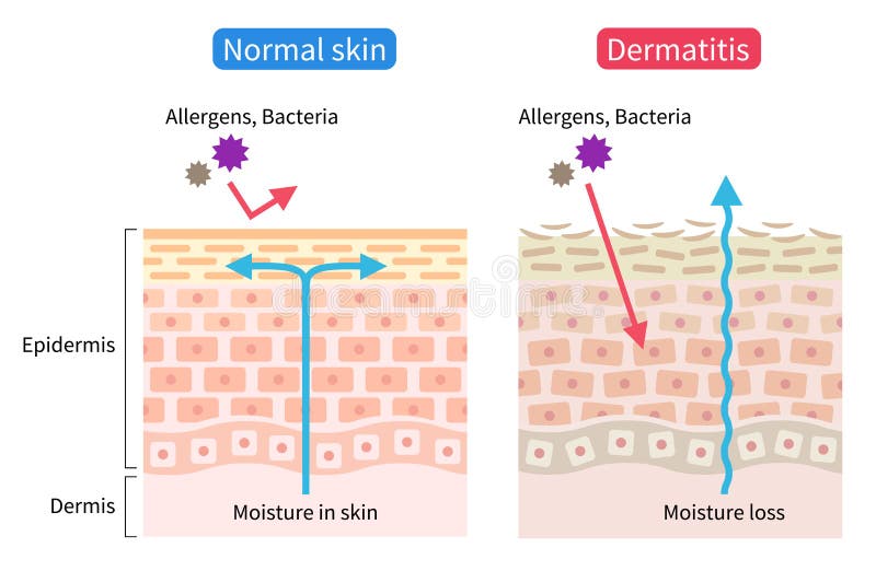 Atopic Dermatitis Eczema Dry And Normal Skin Cell Illustration Healthy