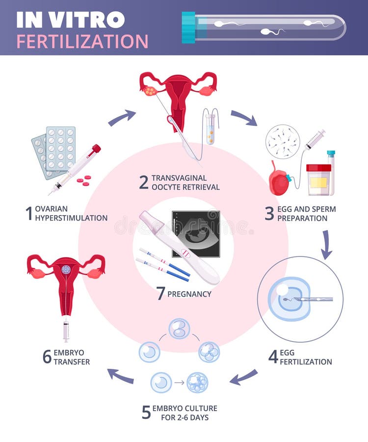 Fécondation in Vitro Plate IVF Infographics Illustration de Vecteur ...