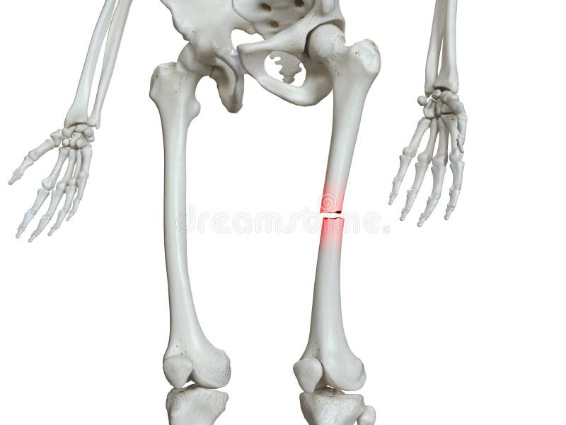 Hueso Del Fémur Del Perro Roto Con Otros Huesos Visibles Stock de ...