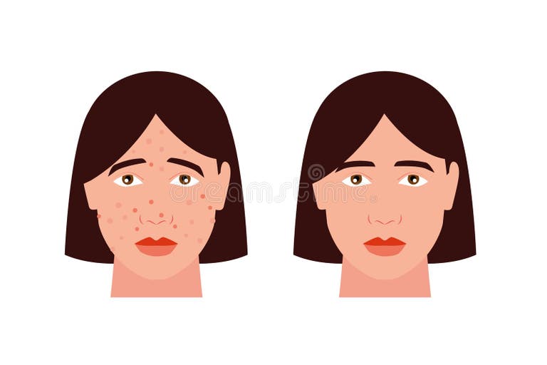 Collagen Acne Stock Illustrations – 2,429 Collagen Acne Stock ...