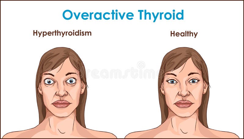 Vector - Symptoms Of High Blood Pressure Hypertension Stock Vector ...