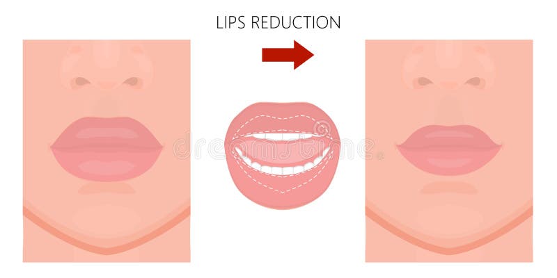 Face Front_Upper and Lower Lips Reduction Stock Vector - Illustration ...