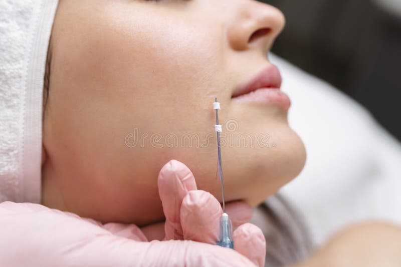 Face Lifting PDO Suture Operation. Innovative Technique of New Thread ...